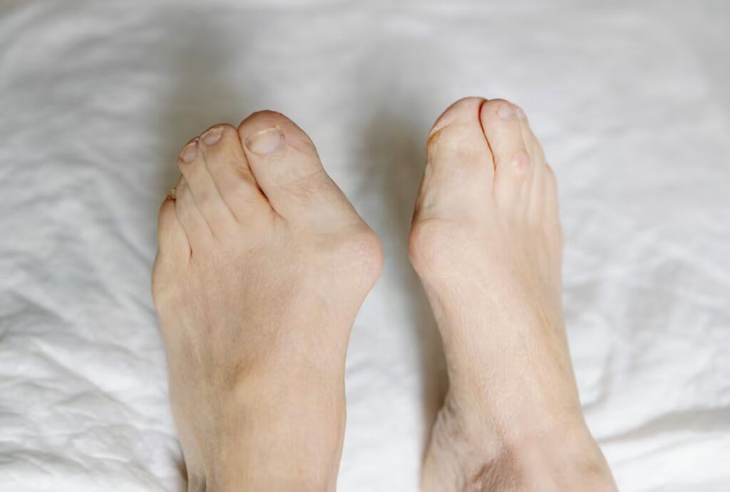 Bunions - Manchester Feet